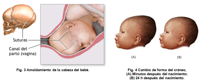Fig 3 Amoldamiento Del Craneo Del Bebe Fisiobym